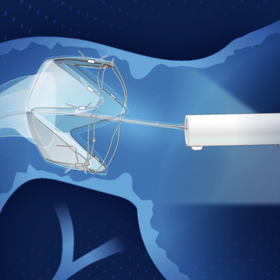 RESET® An Endoscopic Treatment for Obesity - Morphic Medical